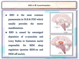 REM behaviour disorder and dementia with Lewy bodies | PPTX