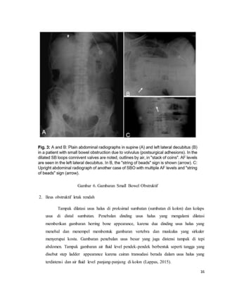 Rbd ileus fix | DOCX