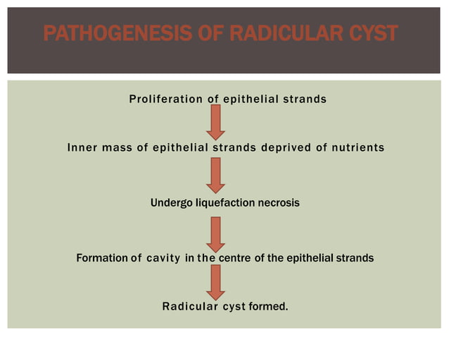 Radicular cyst | PPTX | Dental Health | Diseases and Conditions