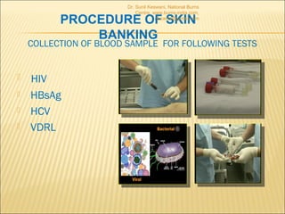 Rcbn skin bank by Dr. Sunil Keswani, National Burns Centre, Airoli | PPT
