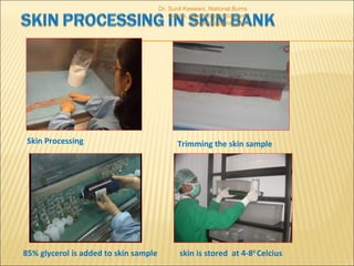 Rcbn skin bank by Dr. Sunil Keswani, National Burns Centre, Airoli | PPT