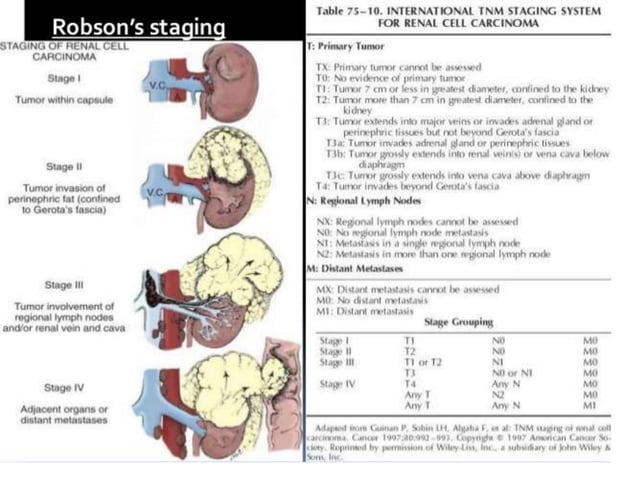 RCC- Staging and treatment of Renal Cell Carcinoma | PPTX
