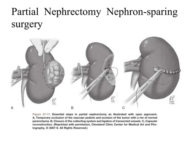 RCC- Staging and treatment of Renal Cell Carcinoma | PPTX