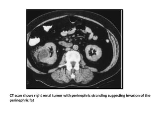 RCC renal cell carcinoma and it's managemnet | PPTX