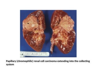 RCC renal cell carcinoma and it's managemnet | PPTX
