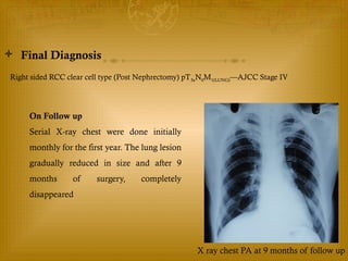 spontaneous regression in renal cell carcinoma:pptx | PPTX