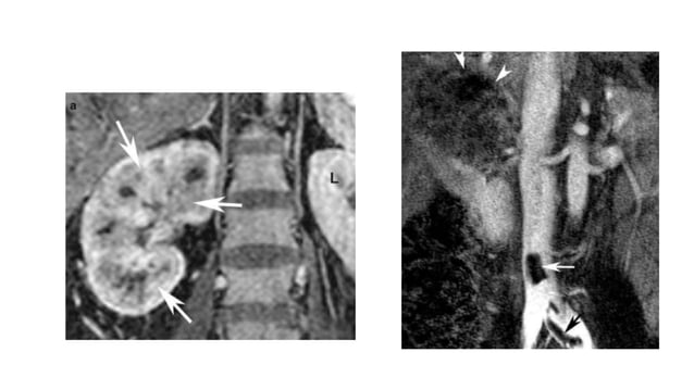 imaging in RCC | PPT