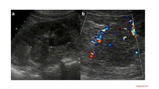 imaging in RCC | PPTX