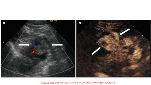 imaging in RCC | PPT