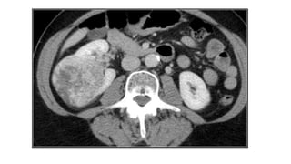 imaging in RCC | PPTX