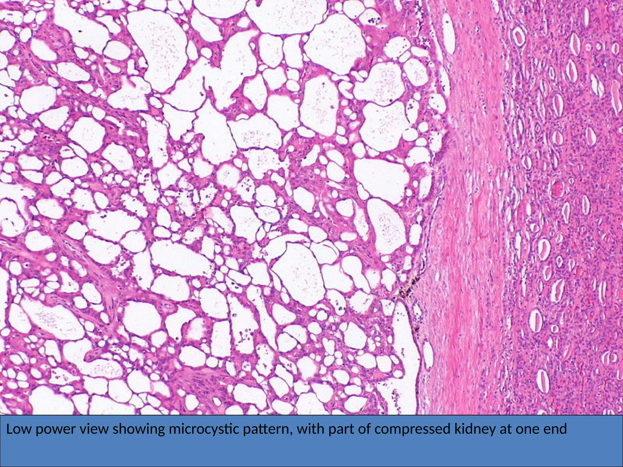 Adult epithelial renal tumors and update of WHO classification of renal ...