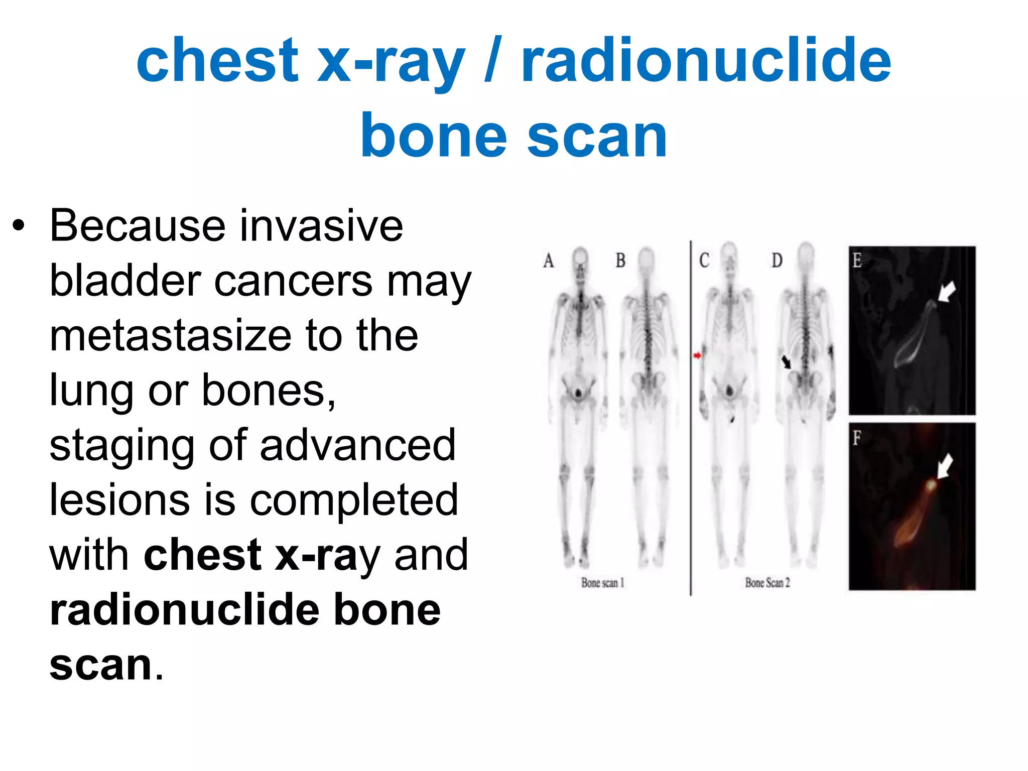 Rcc and bladder cancer | PPT