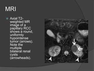 Renal Cell Carcinoma Mri