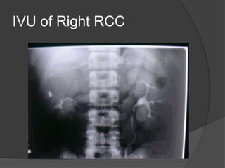 renal cell carcinoma radiology | PPTX