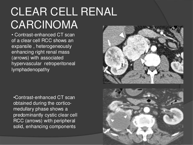renal cell carcinoma radiology