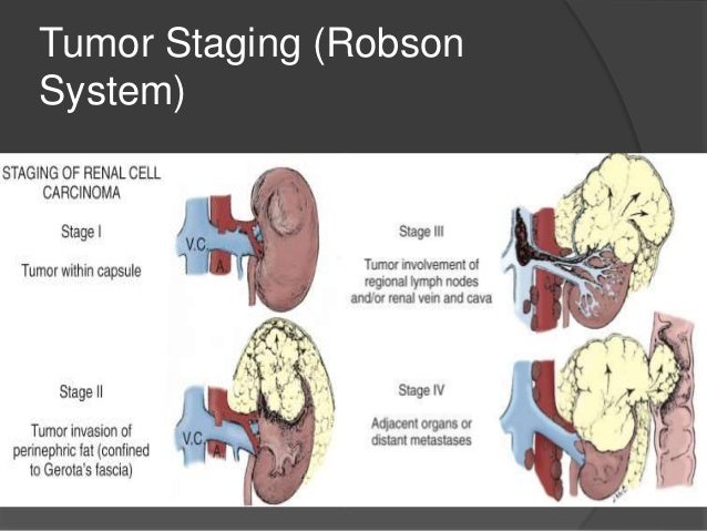 renal cell carcinoma radiology