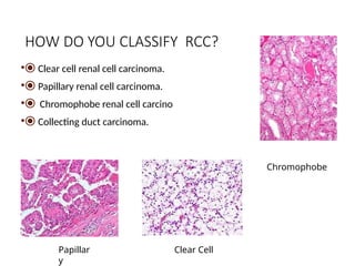 renal cell carcinoma,it gross/microscopy | PPTX