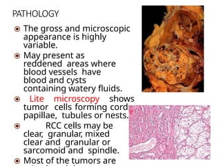 renal cell carcinoma,it gross/microscopy | PPTX