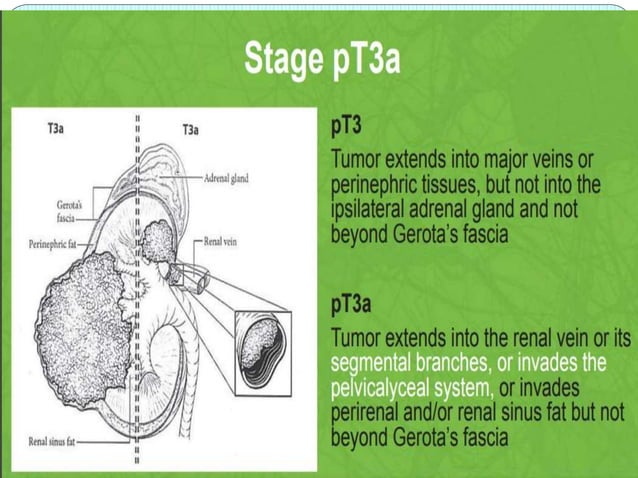 Renal Cell Carcinoma Risk Stratification | PPTX