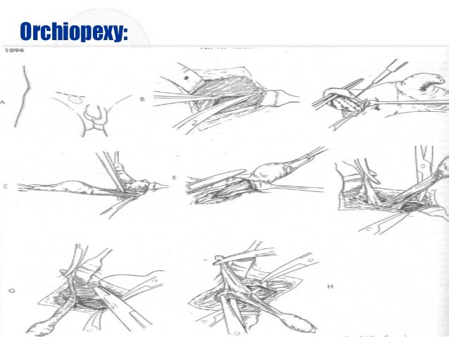 Orchidopexy Def