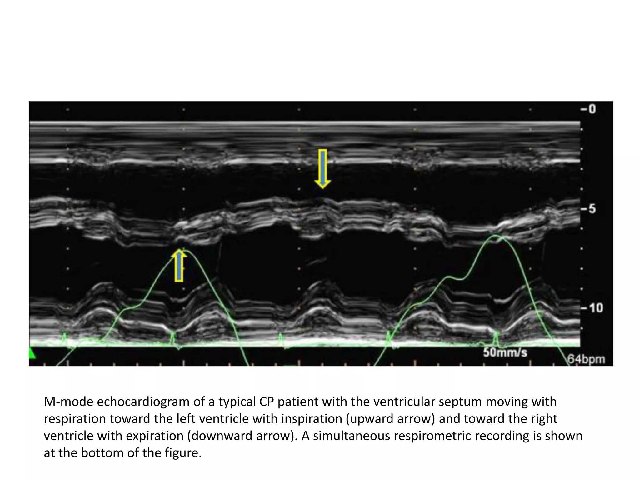 Echo Differentiation of Restrictive Cardiomyopathy and Constrictive ...