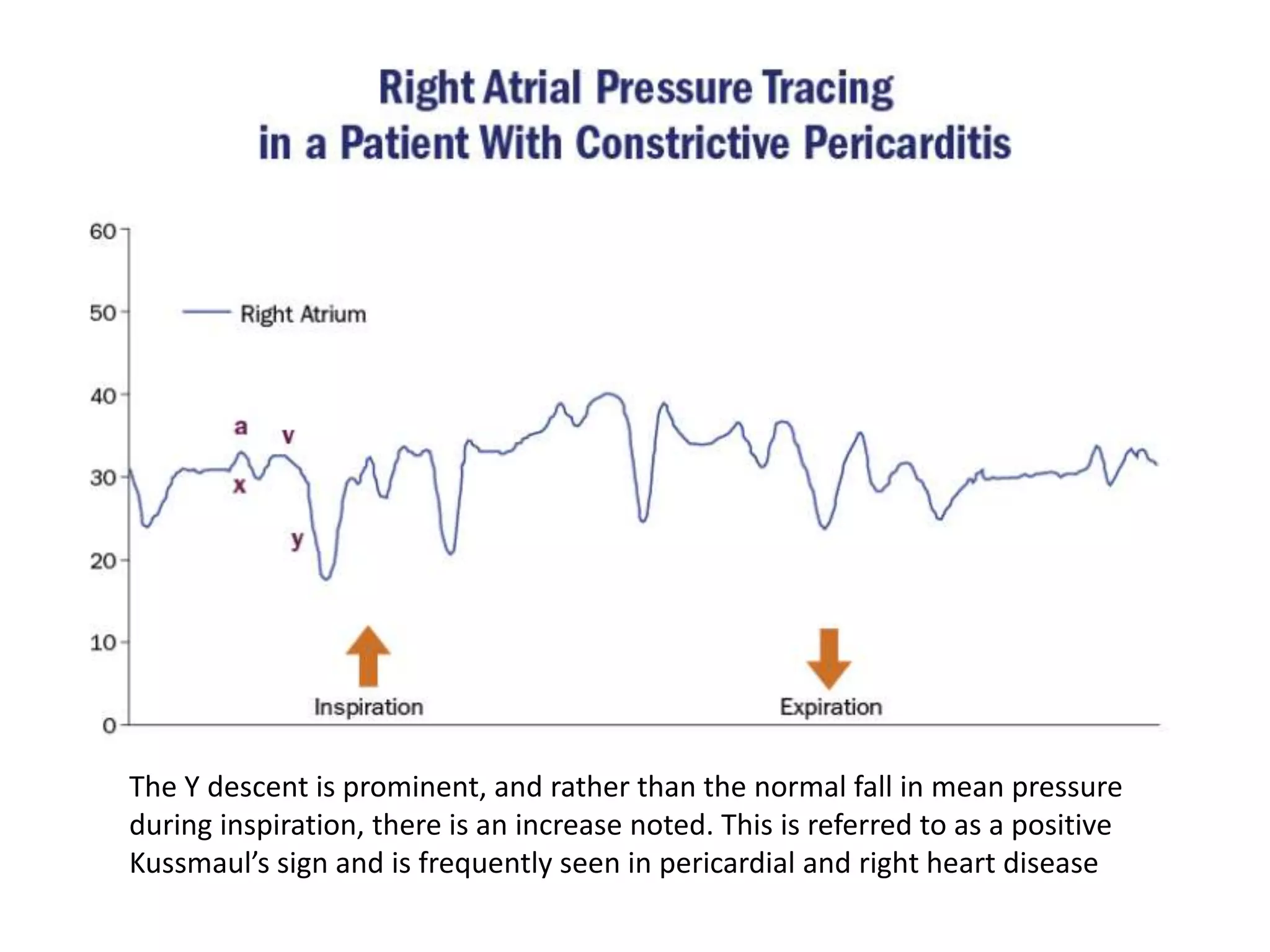 Echo Differentiation of Restrictive Cardiomyopathy and Constrictive ...