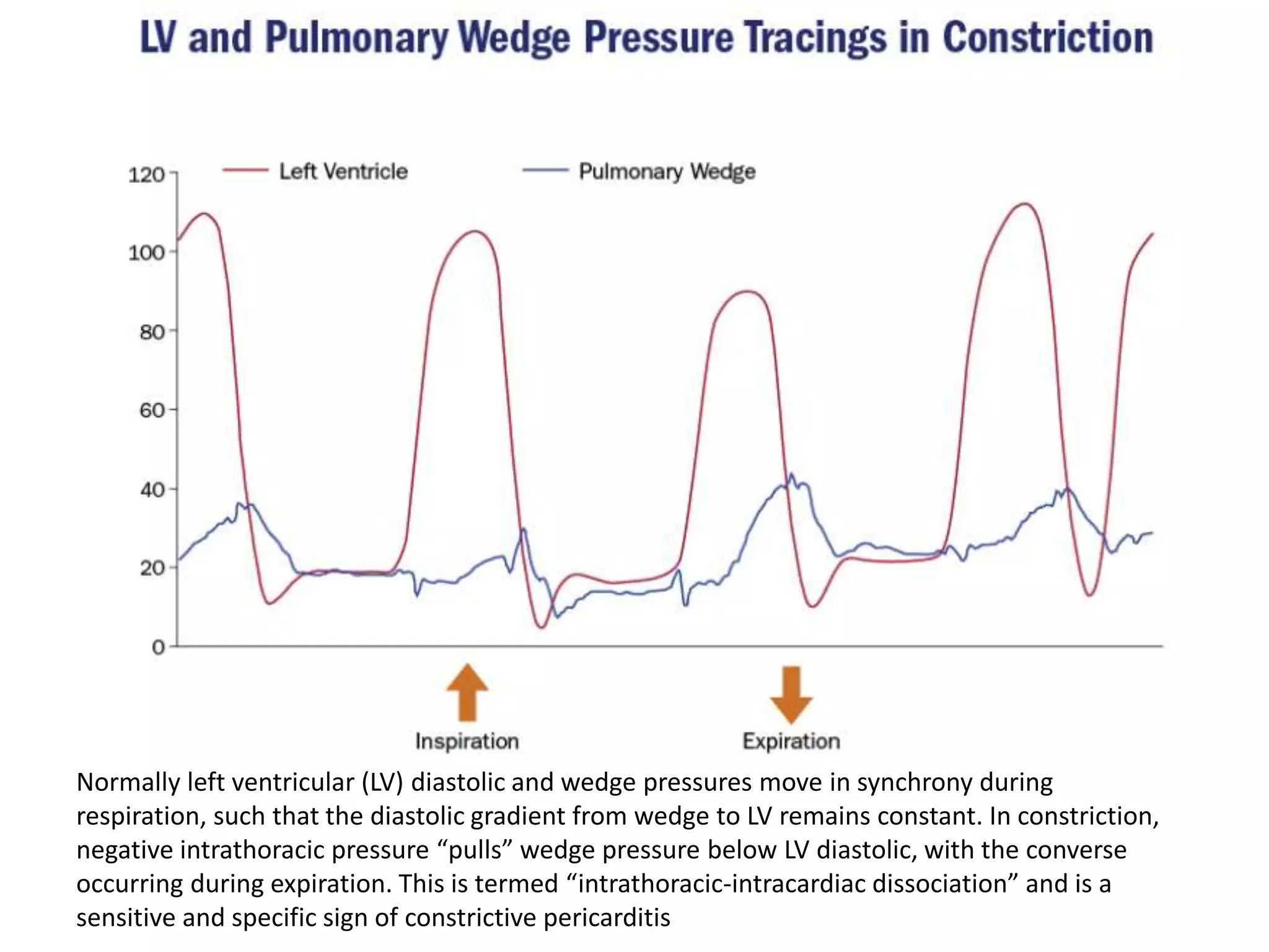 Echo Differentiation of Restrictive Cardiomyopathy and Constrictive ...