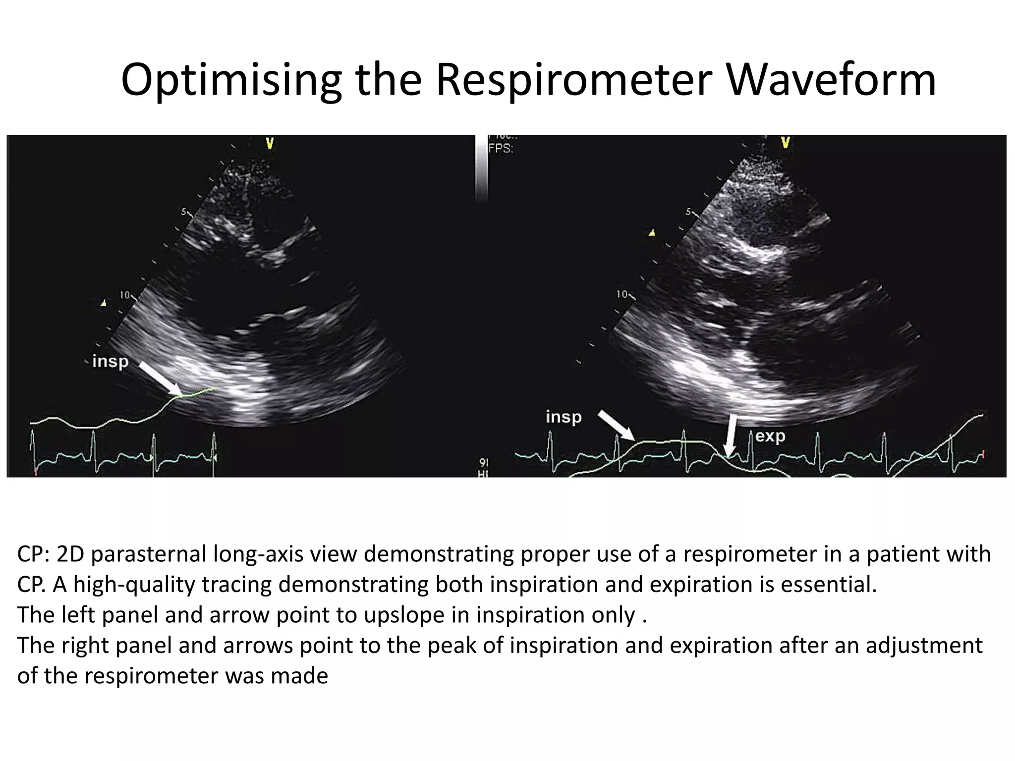 Echo Differentiation of Restrictive Cardiomyopathy and Constrictive ...