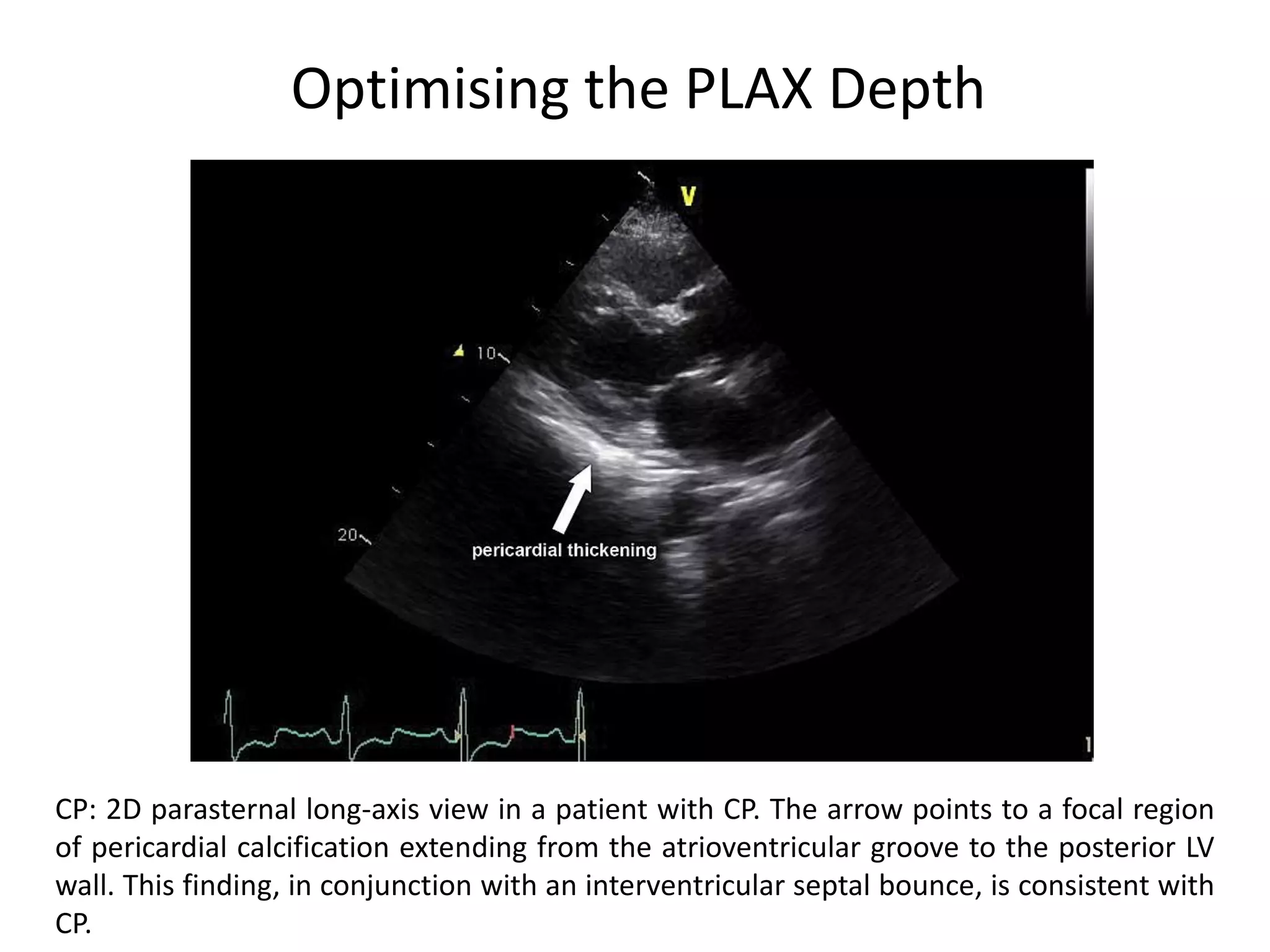 Echo Differentiation of Restrictive Cardiomyopathy and Constrictive ...