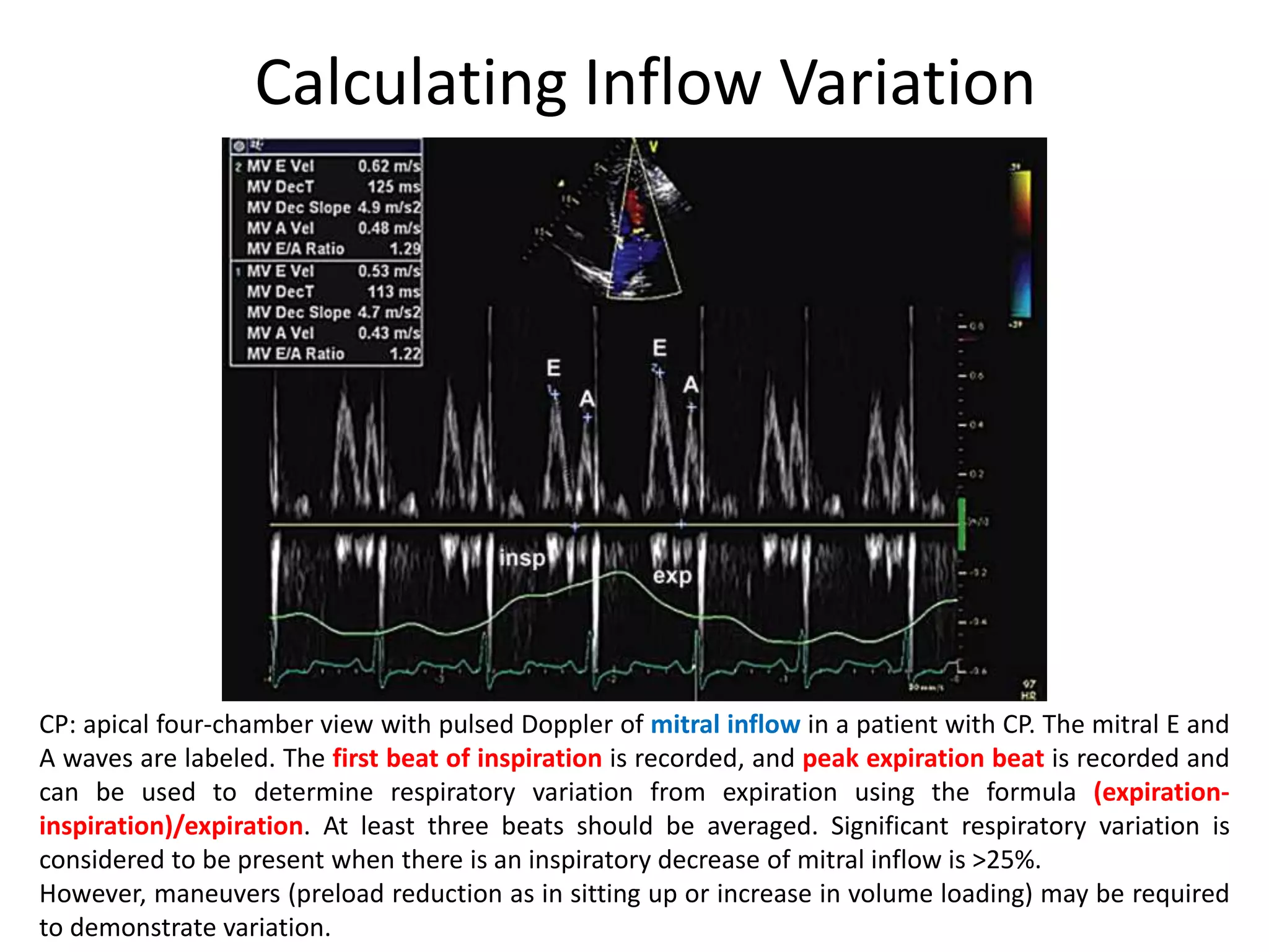 Echo Differentiation of Restrictive Cardiomyopathy and Constrictive ...