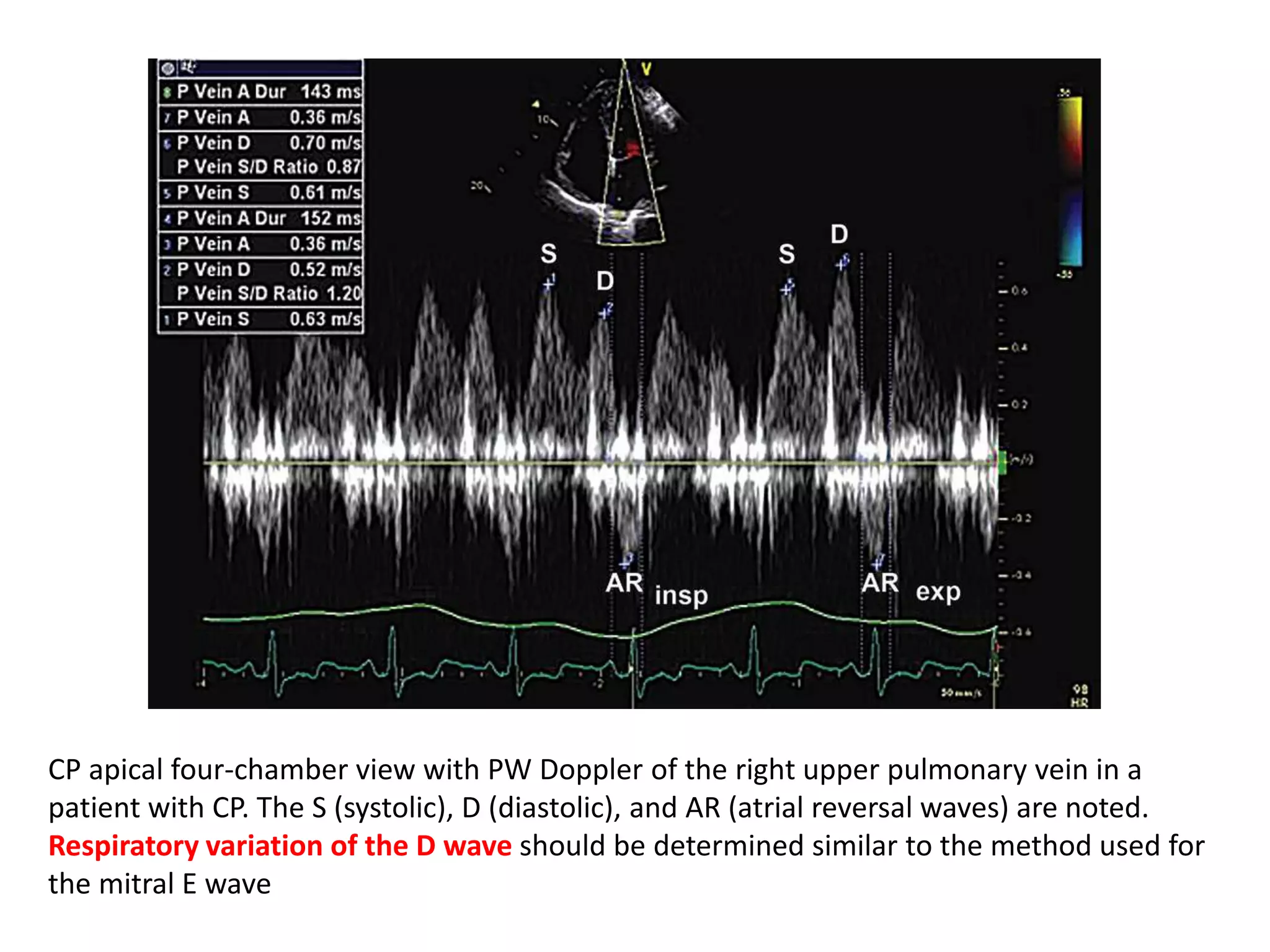 Echo Differentiation of Restrictive Cardiomyopathy and Constrictive ...