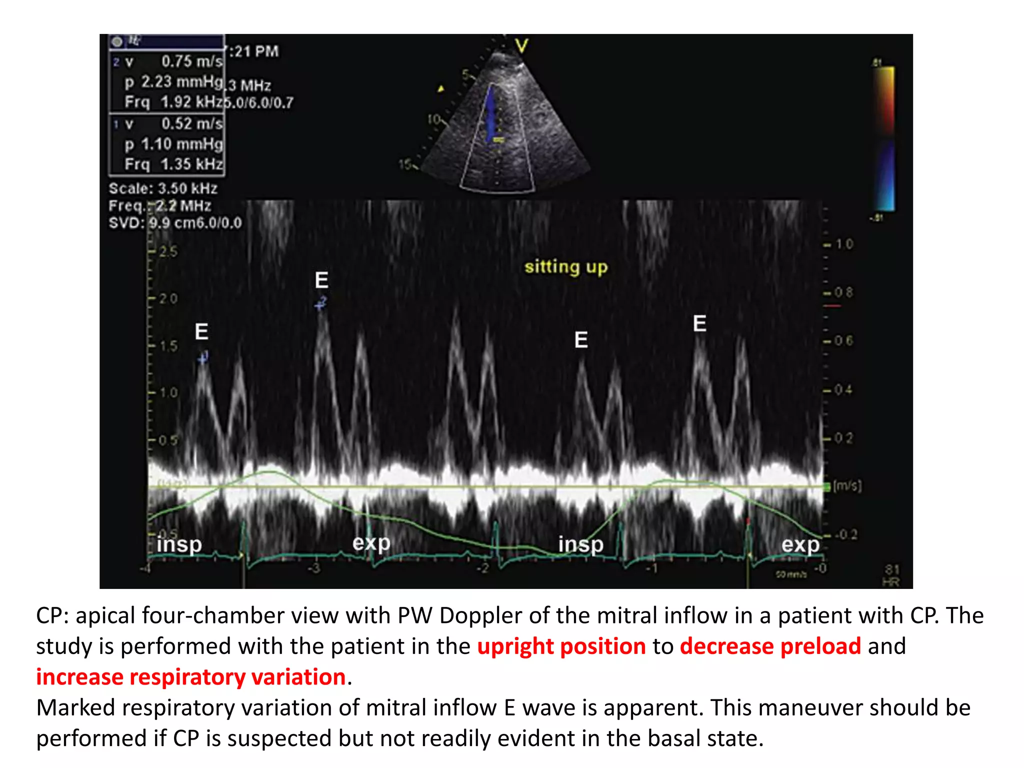 Echo Differentiation of Restrictive Cardiomyopathy and Constrictive ...