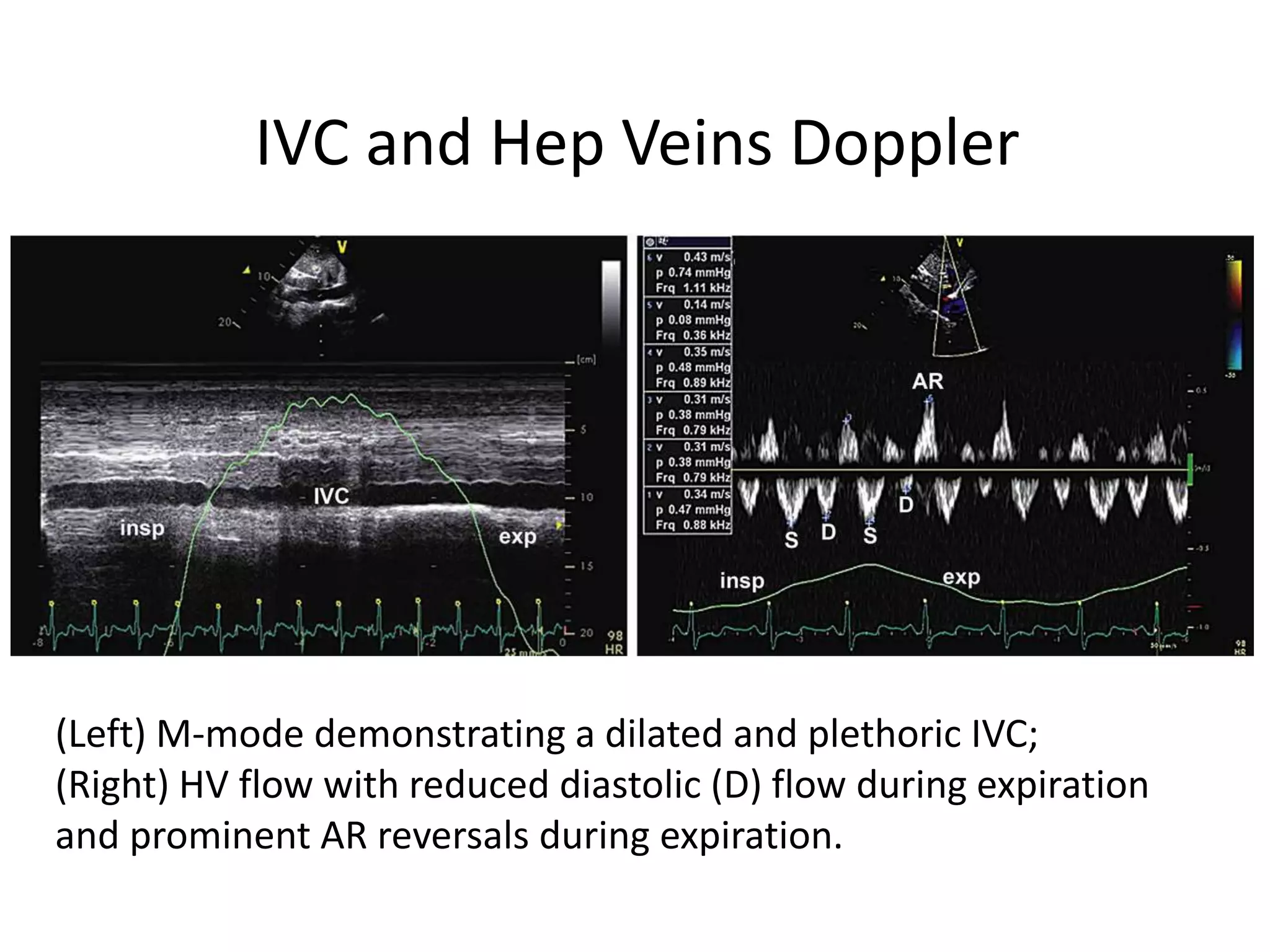 Echo Differentiation of Restrictive Cardiomyopathy and Constrictive ...