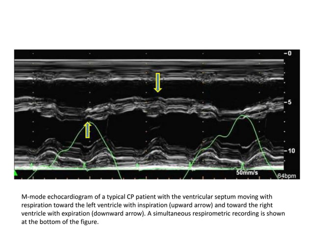 Echo Differentiation of Restrictive Cardiomyopathy and Constrictive ...