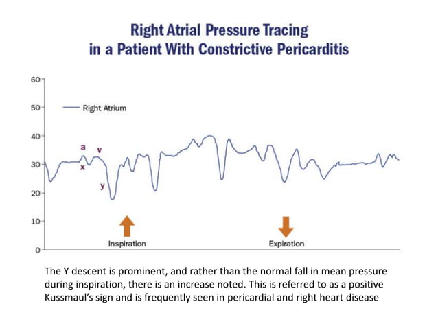 Echo Differentiation of Restrictive Cardiomyopathy and Constrictive ...