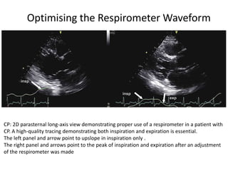 Echo Differentiation of Restrictive Cardiomyopathy and Constrictive ...