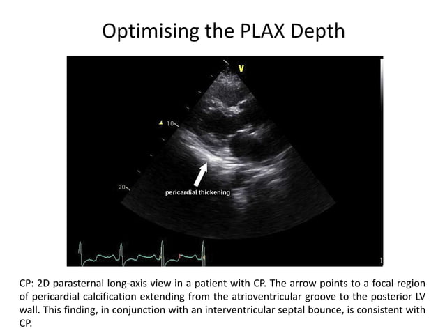 Echo Differentiation of Restrictive Cardiomyopathy and Constrictive ...