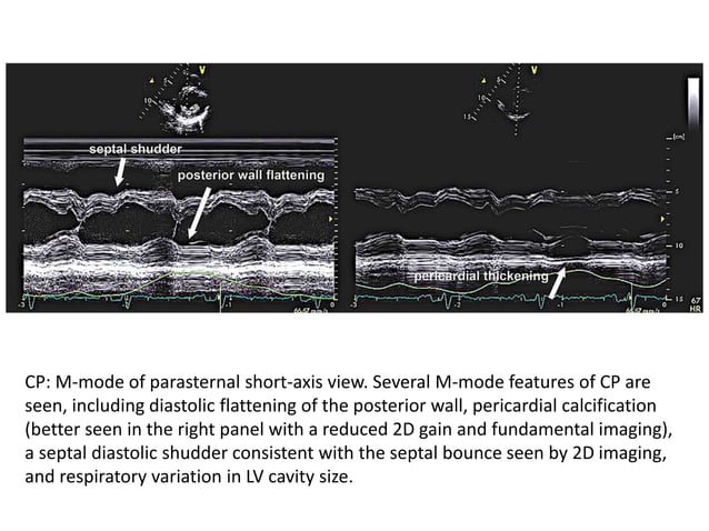 Echo Differentiation of Restrictive Cardiomyopathy and Constrictive ...