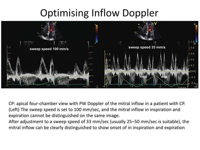 Echo Differentiation of Restrictive Cardiomyopathy and Constrictive ...