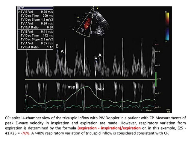 Echo Differentiation of Restrictive Cardiomyopathy and Constrictive ...