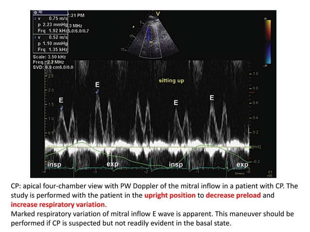 Echo Differentiation of Restrictive Cardiomyopathy and Constrictive ...
