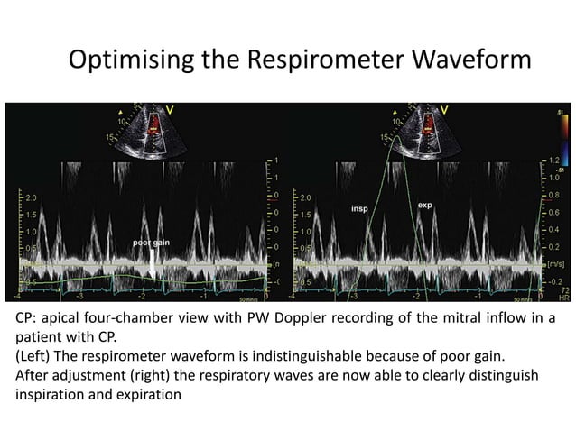 Echo Differentiation of Restrictive Cardiomyopathy and Constrictive ...