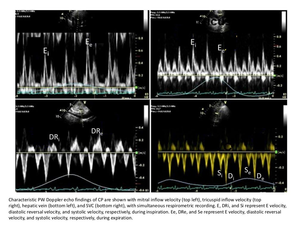 Echo Differentiation of Restrictive Cardiomyopathy and Constrictive P…