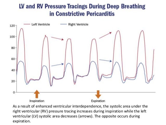 Echo Differentiation of Restrictive Cardiomyopathy and Constrictive P…