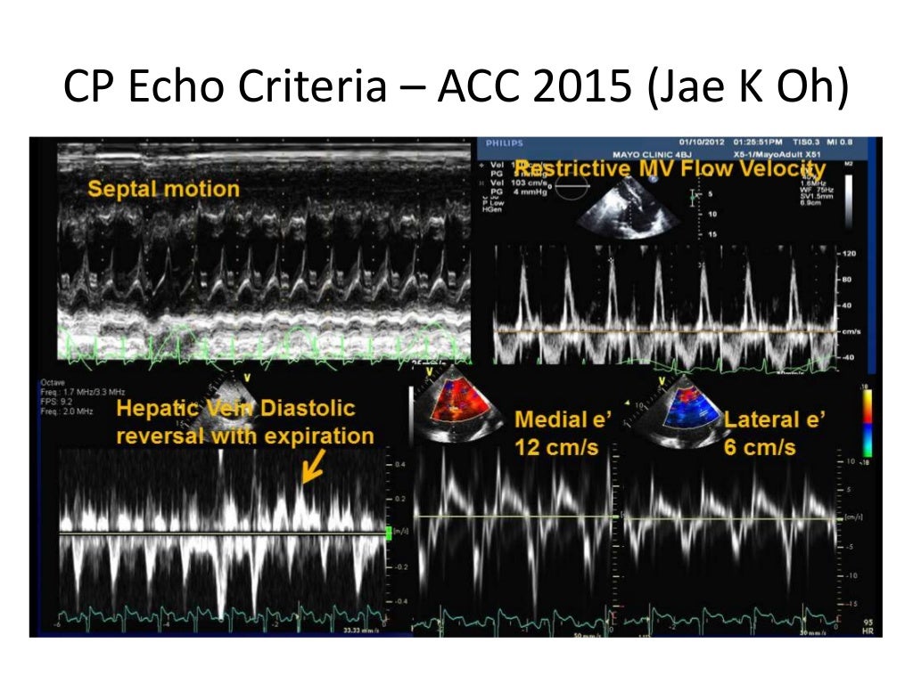Echo Differentiation of Restrictive Cardiomyopathy and Constrictive P…
