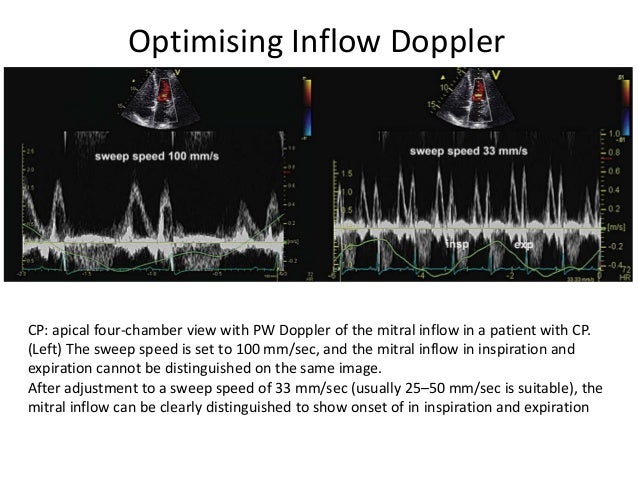 Echo Differentiation of Restrictive Cardiomyopathy and Constrictive P…