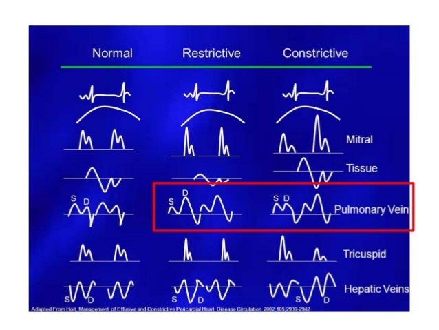Echo Differentiation of Restrictive Cardiomyopathy and Constrictive P…