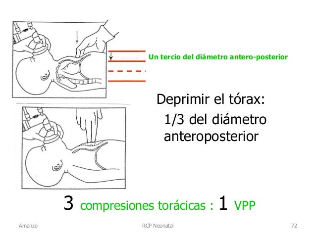 RCP Neonatal