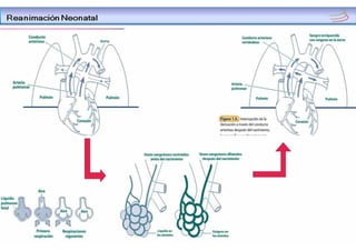 RCP NEONATAL (1). CON BUENA REANIMACION NEONATAL | PDF