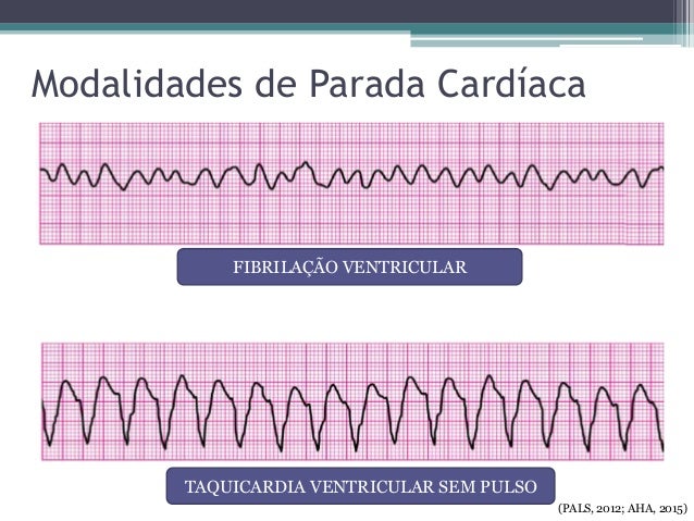 Novas diretrizes de Reanimação Cardiopulmonar Neopediátrica